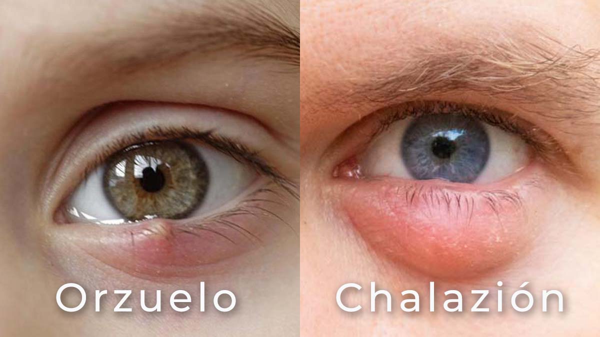 En solo 3 días, descubre cómo deshacerte de una perrilla de forma ...